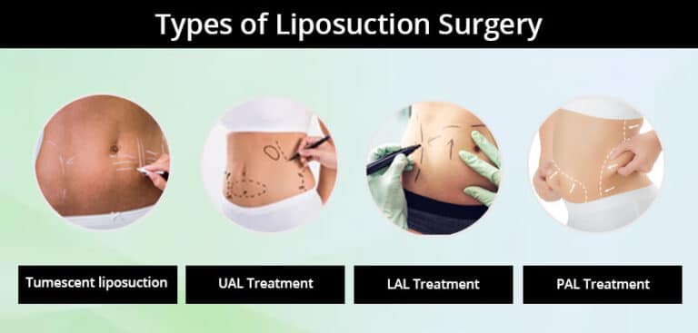 Liposuction surgery in Jaipur by Dr. Buddhi Prakash at Cosmo-Hair